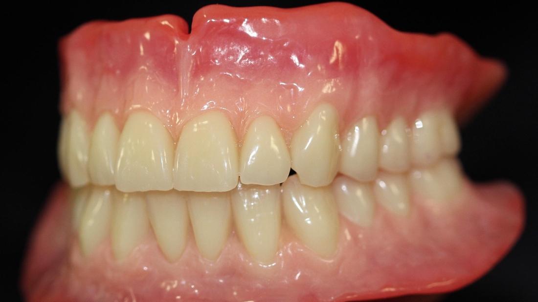 Center for Progressive Dentistry | Case of the Week- New Dentures